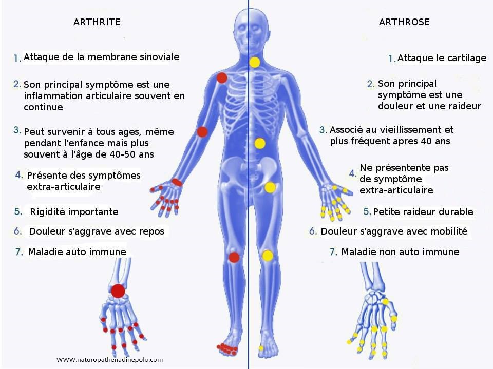 Arthrite , Arthrose comment faire la différence. – Naturopathe ...
